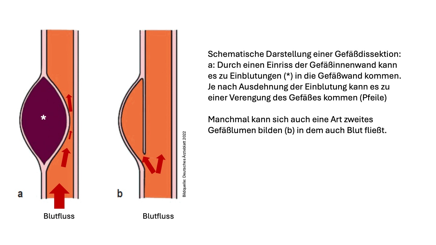 Gefäßdissektion – auf dem Weg zur individualisierten Therapie